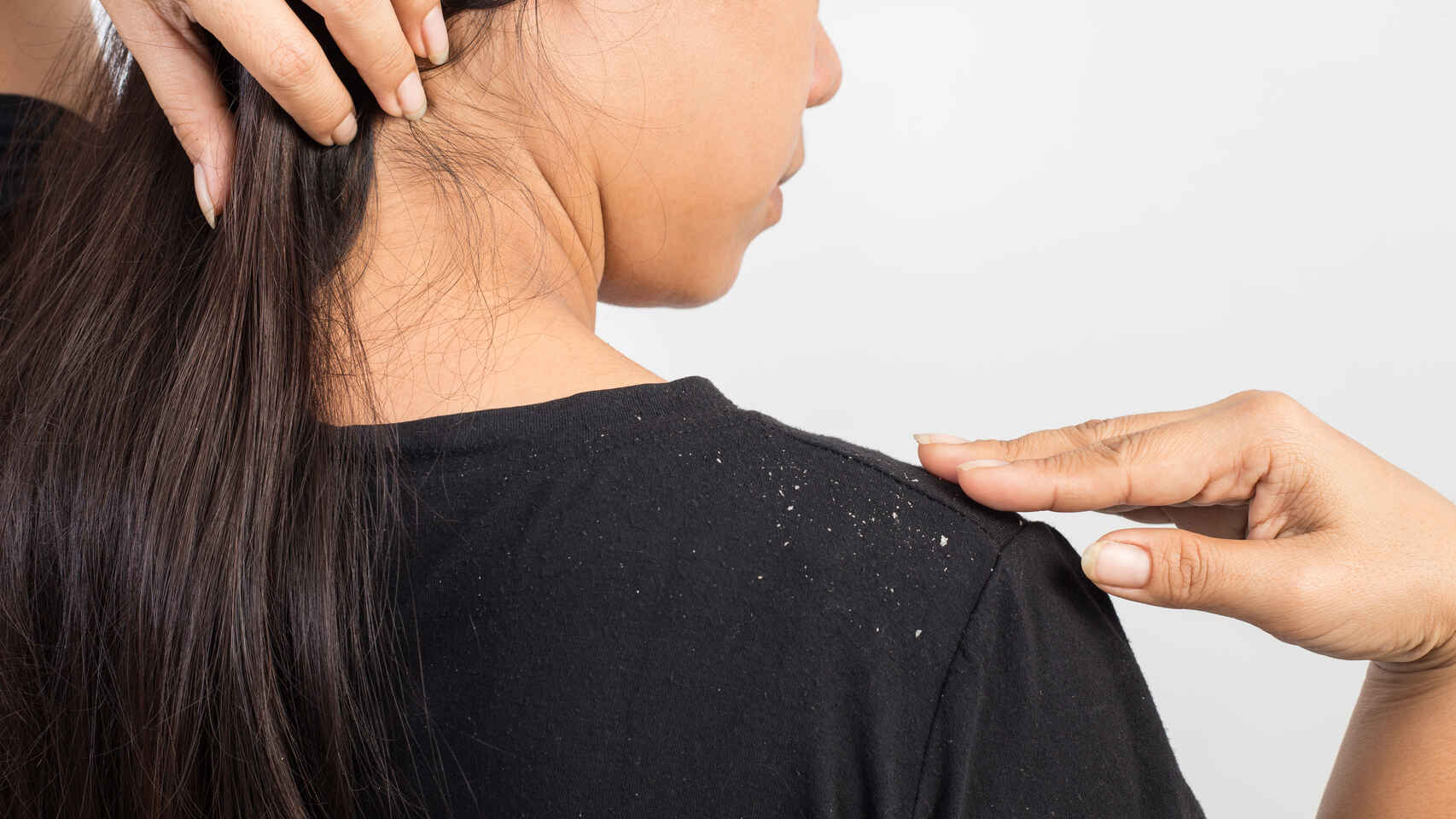 ¿Qué es la caspa y cómo solucionarla?