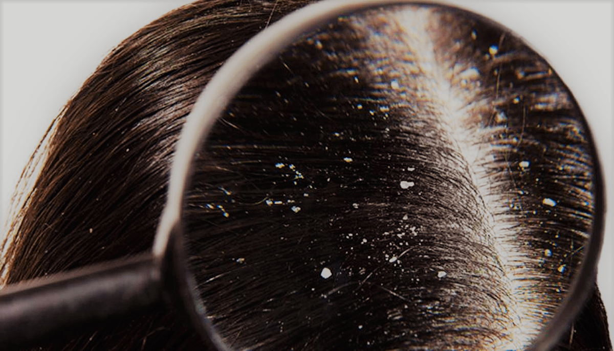 ¿Qué es la caspa y cómo solucionarla?