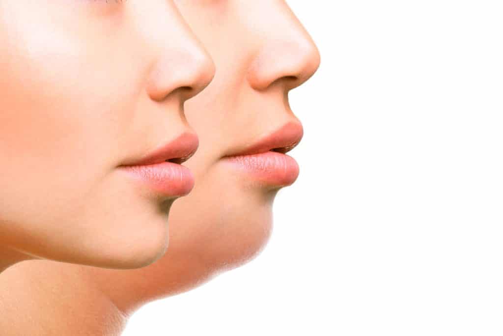 ¿Qué es la liposucción para reducción de papada?