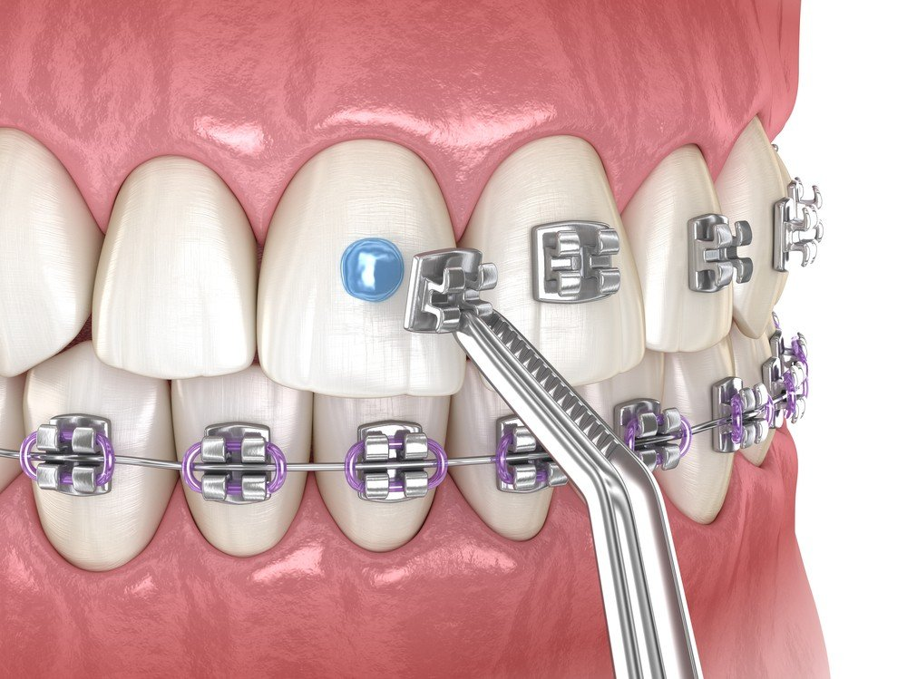 5 datos curiosos sobre los brackets