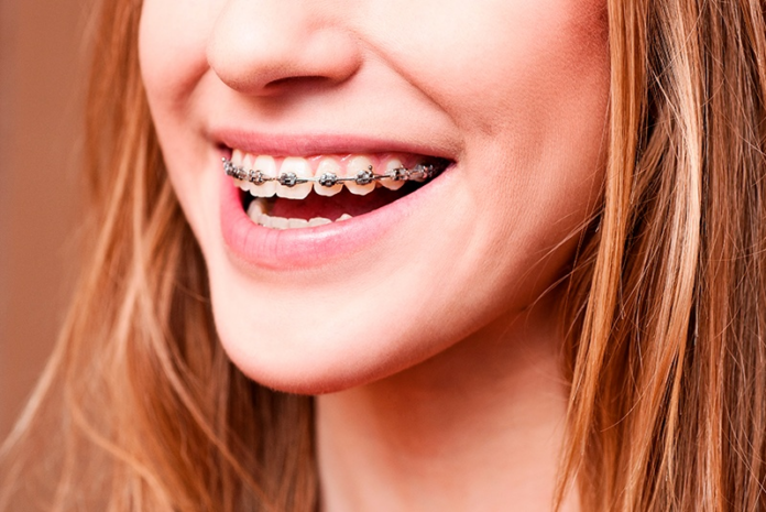 5 datos curiosos sobre los brackets