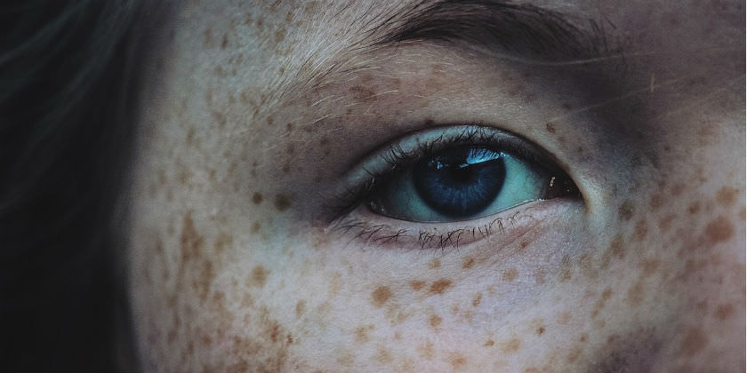 Origen de las pecas en el rostro