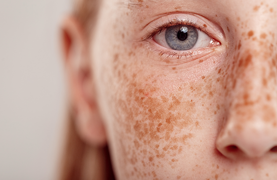 Aprende a distinguir los tipos de manchas en la piel