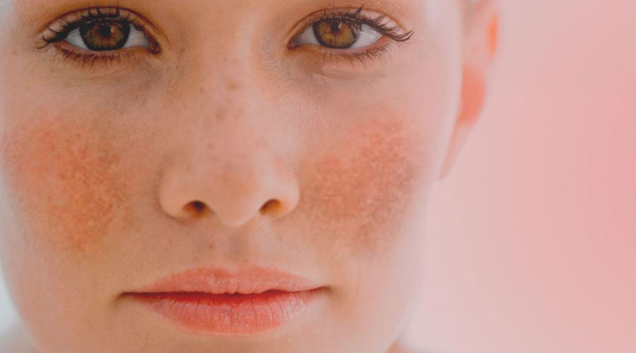 Aprende a distinguir los tipos de manchas en la piel